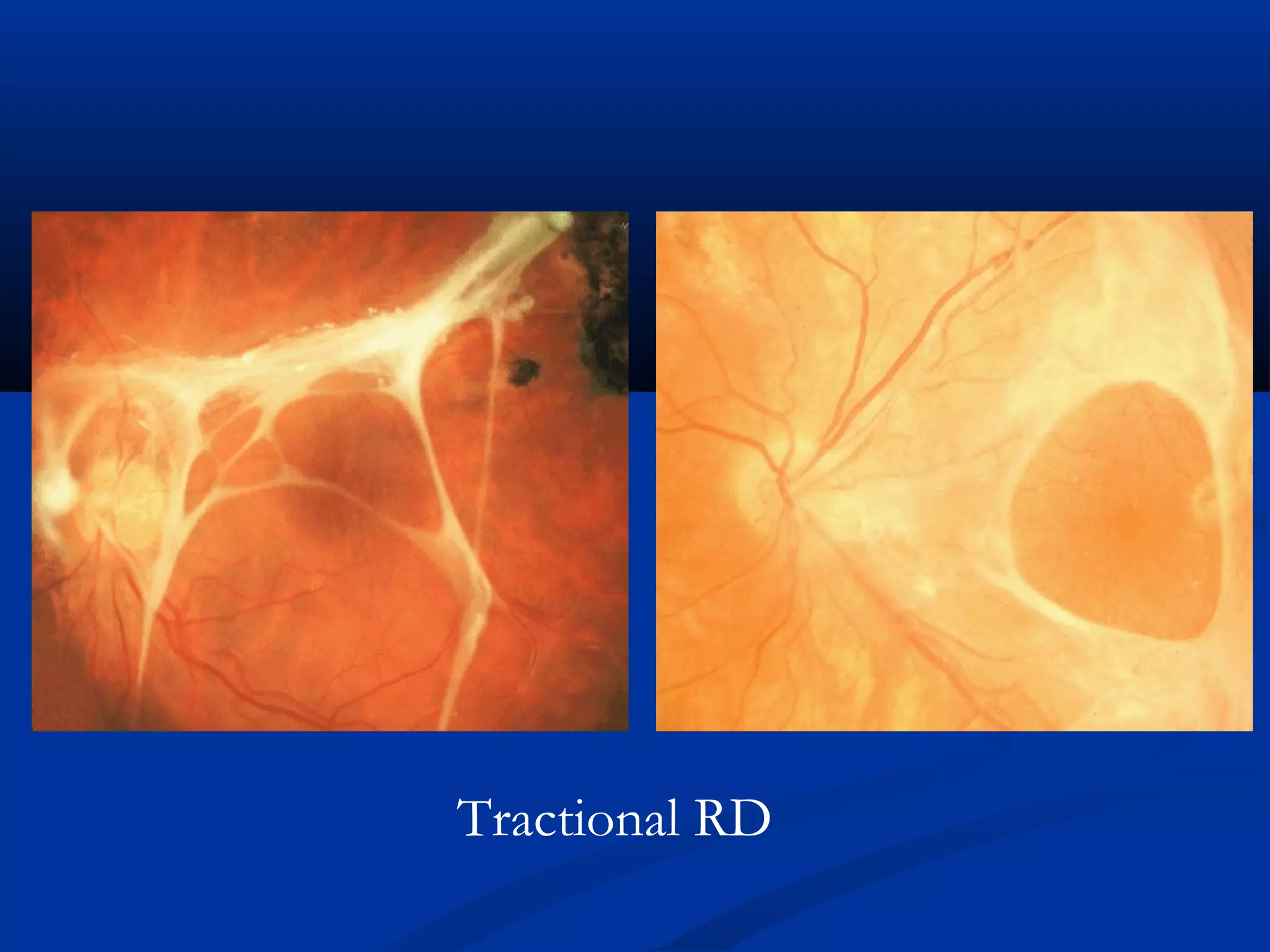 Diabetic ophthalmopathy | PPT