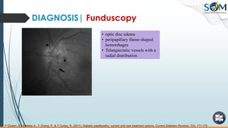 Diabetic Papillopathy | PPTX