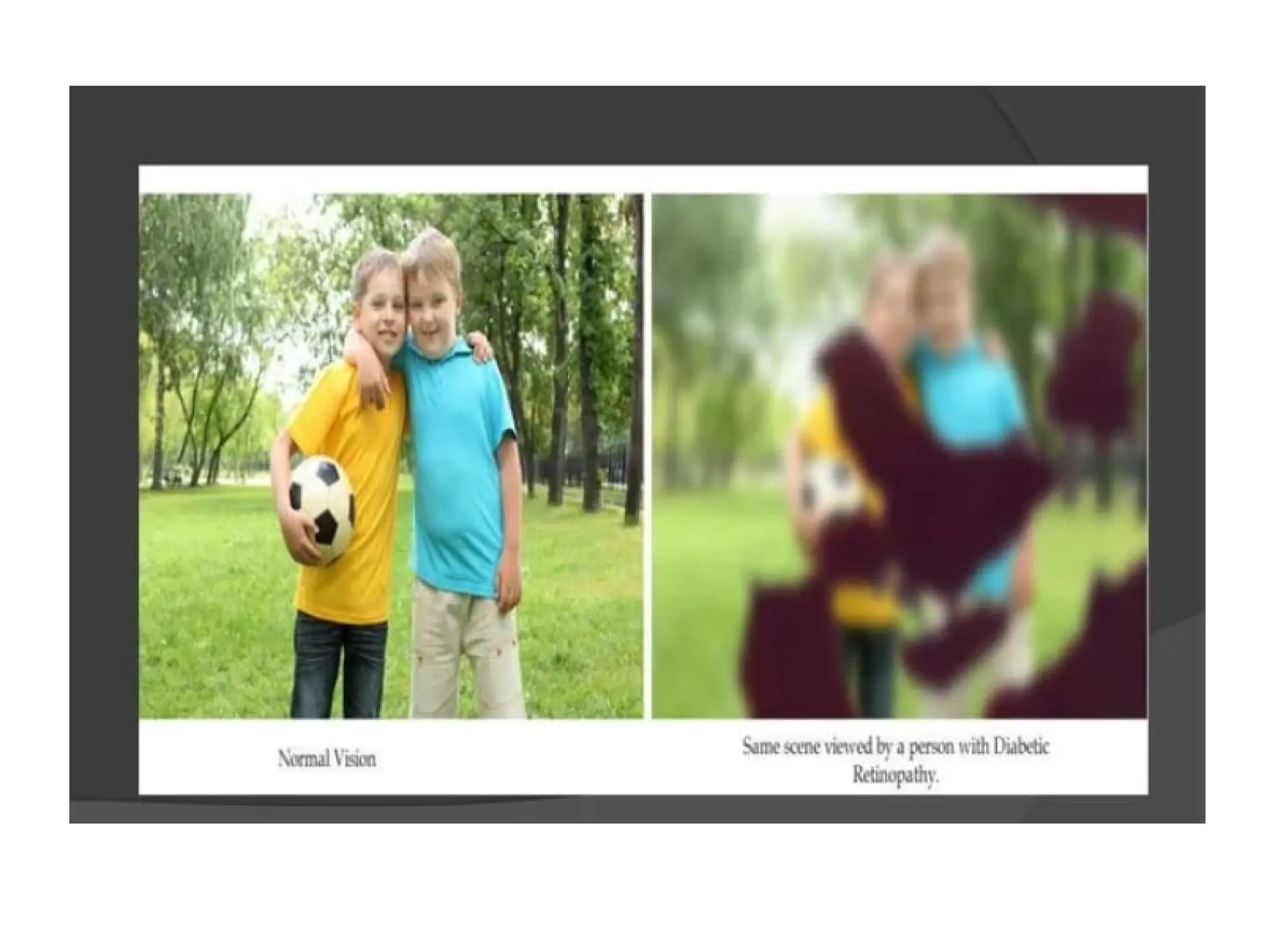 TOPI IS ABOUT DIABETIC RETINOPATHY , DEFINATION TO TREATMENT | PPTX