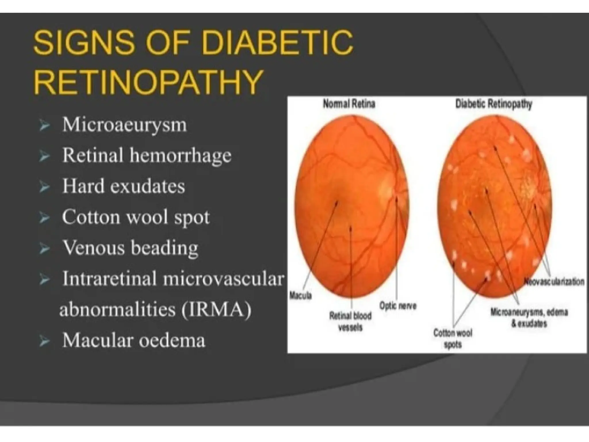 TOPI IS ABOUT DIABETIC RETINOPATHY , DEFINATION TO TREATMENT | PPTX