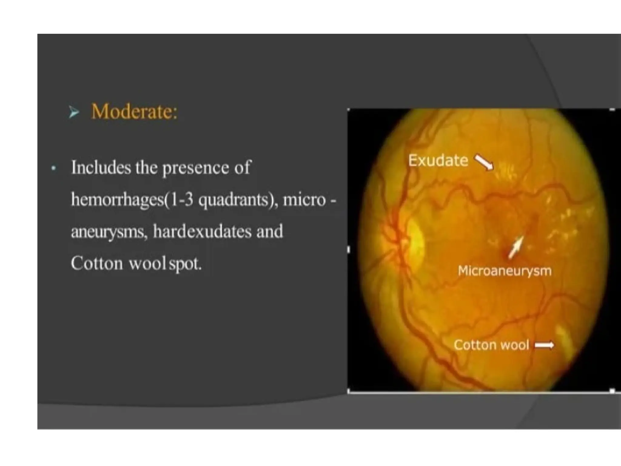 TOPI IS ABOUT DIABETIC RETINOPATHY , DEFINATION TO TREATMENT | PPTX