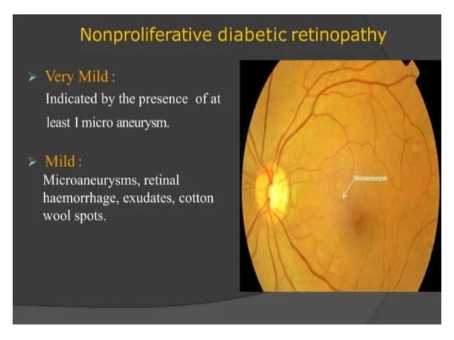 TOPI IS ABOUT DIABETIC RETINOPATHY , DEFINATION TO TREATMENT | PPTX