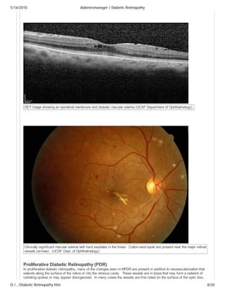 Diabetic retinopathy | PDF