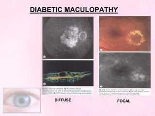 Diffuse Diabetic Maculopathy