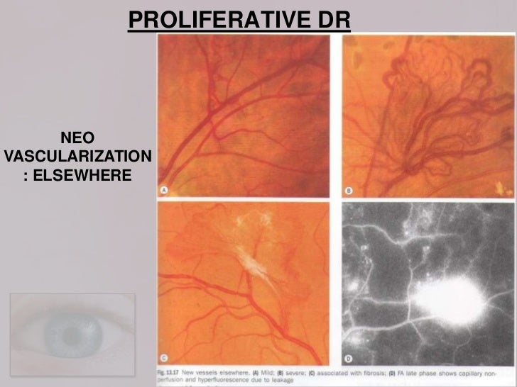 Diabetic retinopathy