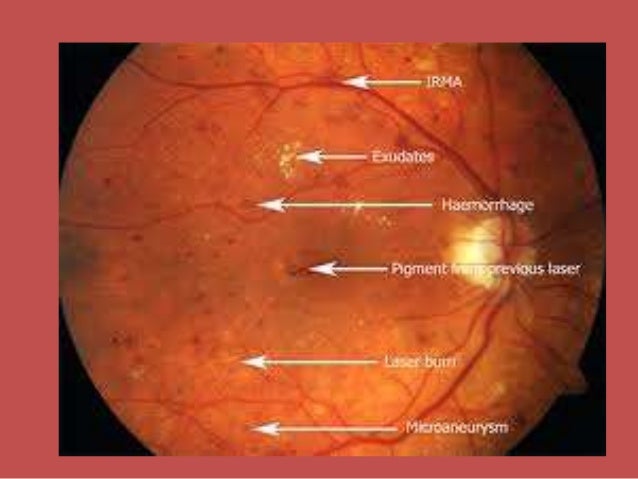 Diabetic retinopathy