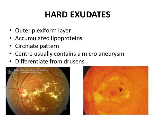 Diabetic retinopathy