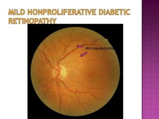 Mild Diabetic Retinopathy