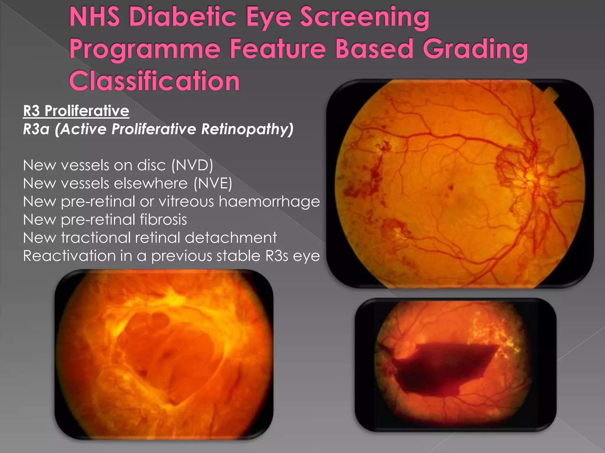 Diabetic retinopathy | PPTX