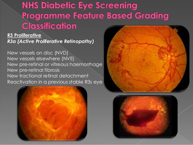 Diabetic retinopathy