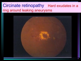 Diabetic retinopathy | PPT