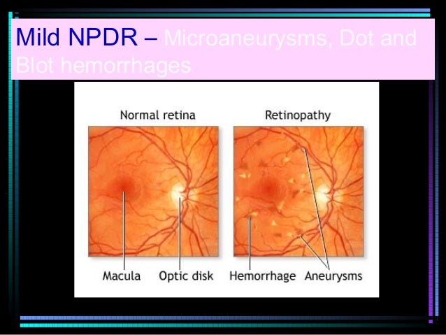 Diabetic retinopathy
