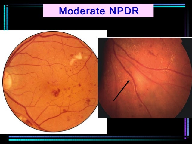 Diabetic retinopathy