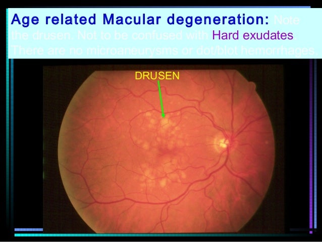 Diabetic retinopathy