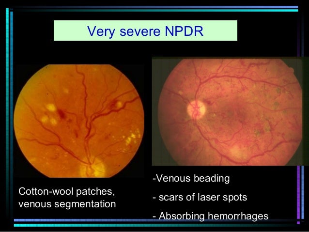 Diabetic retinopathy