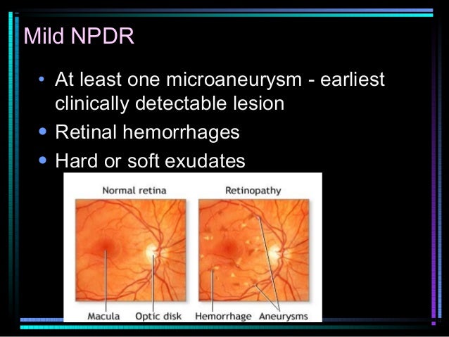 Diabetic retinopathy
