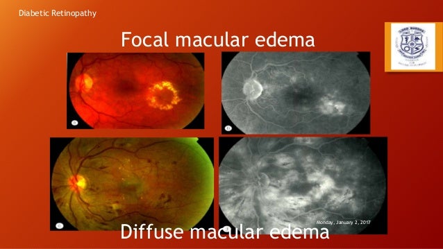 Diabetic retinopathy