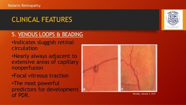 Diabetic retinopathy