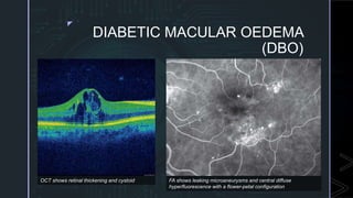Diabetic Retinopathy | PPTX
