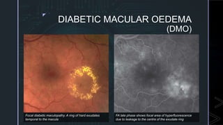 Diabetic Retinopathy | PPTX