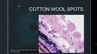 Diabetic Retinopathy | PPT