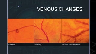 Diabetic Retinopathy | PPT