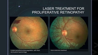 Diabetic Retinopathy | PPTX