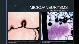 Diabetic Retinopathy | PPT