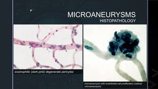 Diabetic Retinopathy | PPT