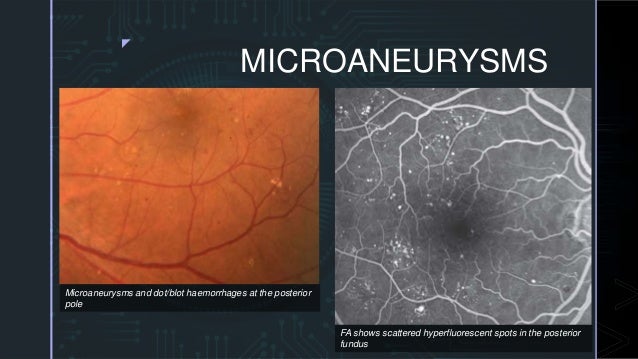 Diabetic Retinopathy