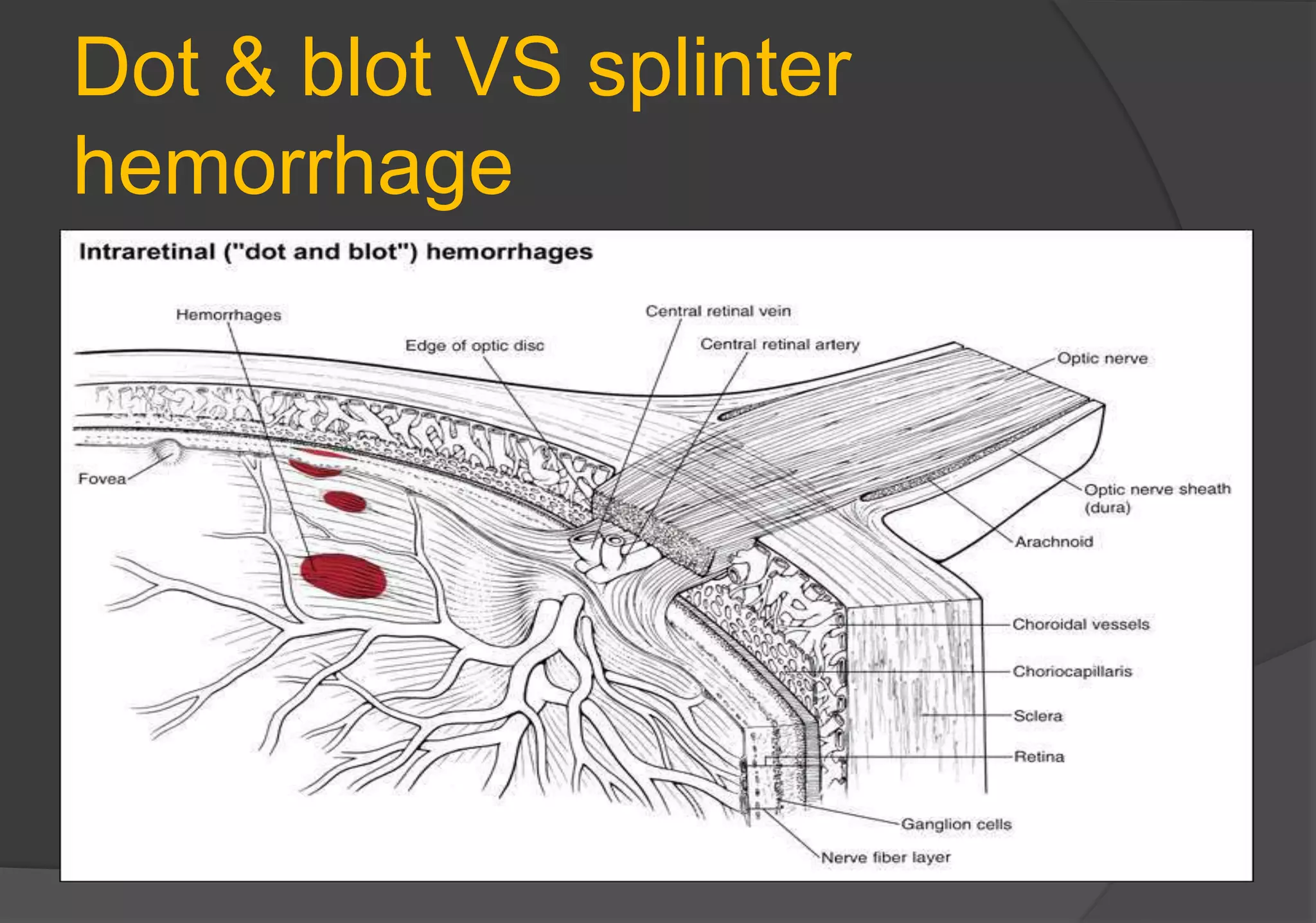 Diabetic retinopathy | PPTX