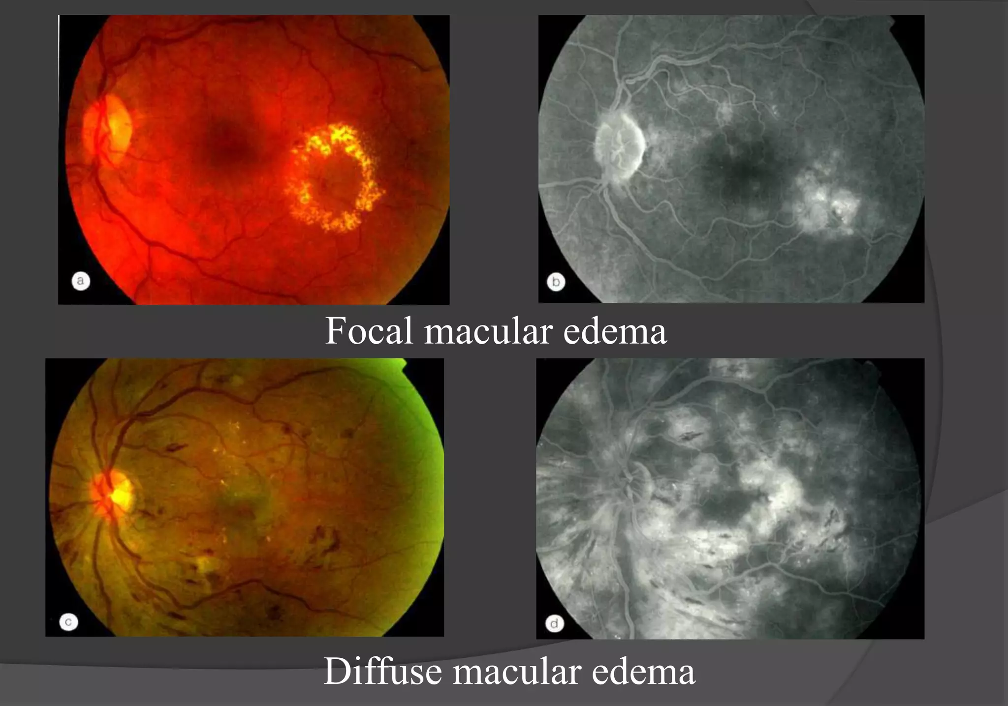 Diabetic retinopathy | PPTX
