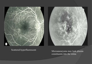 Diabetic retinopathy | PPTX