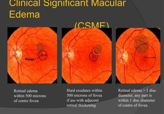 Clinically Significant Macular Edema