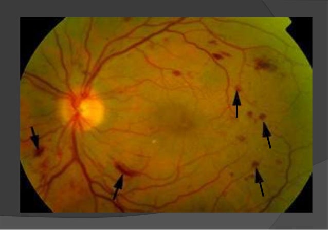 Diabetic retinopathy