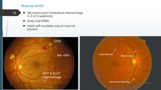 Diabetic retinopathy | PPT