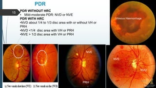Diabetic retinopathy | PPT