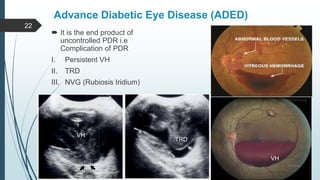 Diabetic retinopathy | PPT