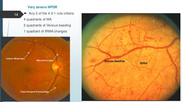Diabetic retinopathy