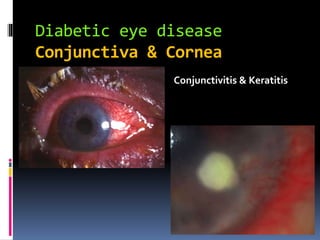 Diabetic retinopathy | PPT
