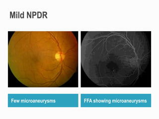 Diabetic retinopathy | PPTX