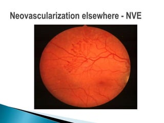 Neovascularization Elsewhere
