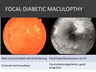 Diffuse Diabetic Maculopathy