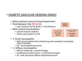 Diabetic retinopathy | PPTX
