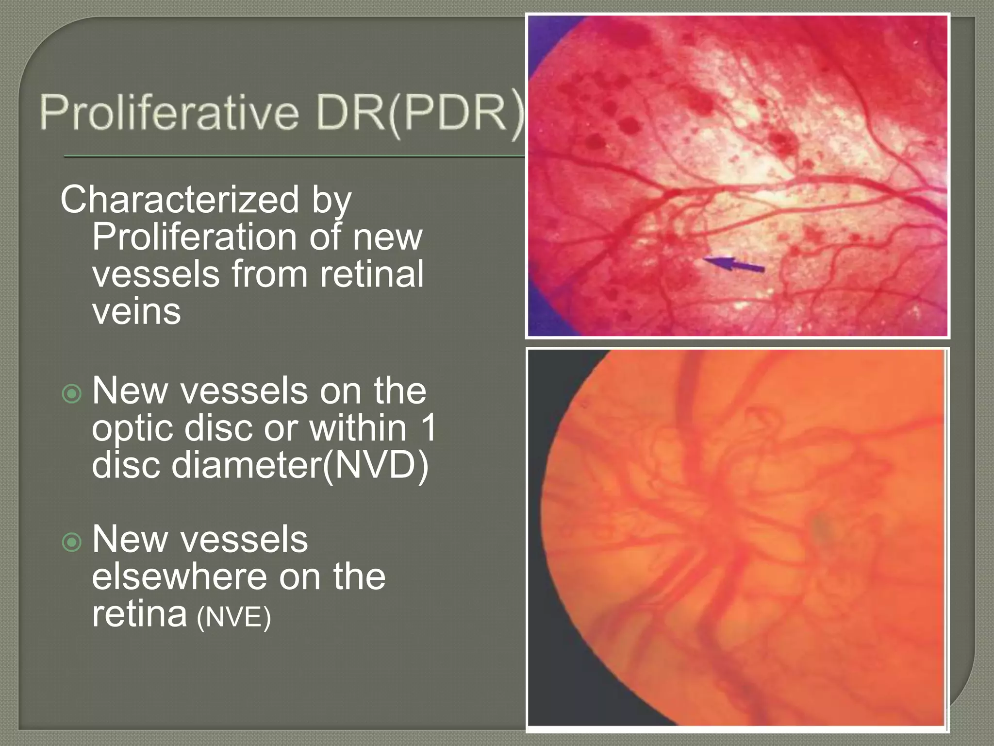 DIABETIC RETINOPATHY.pptx