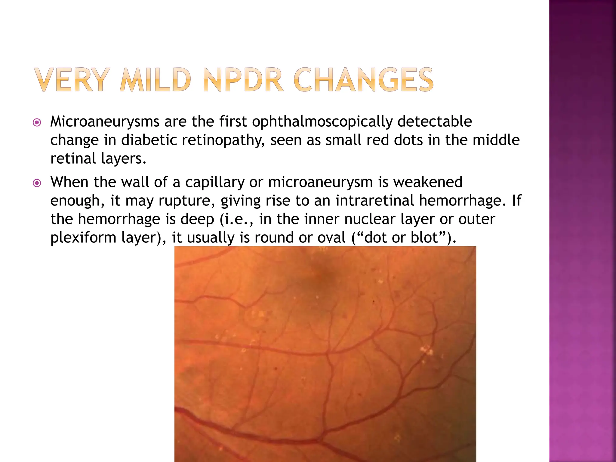 Diabetic retinopathy.pptx on diabetic changes in Retina | PPT
