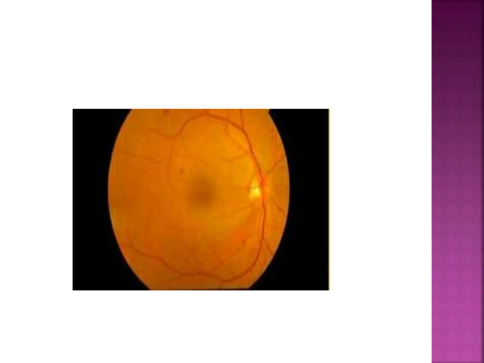 Diabetic retinopathy.pptx on diabetic changes in Retina | PPT