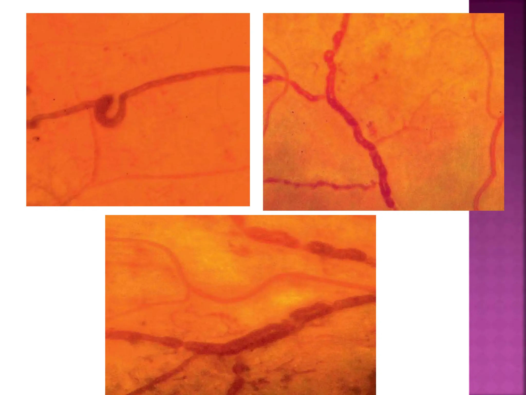 Diabetic retinopathy.pptx on diabetic changes in Retina | PPT