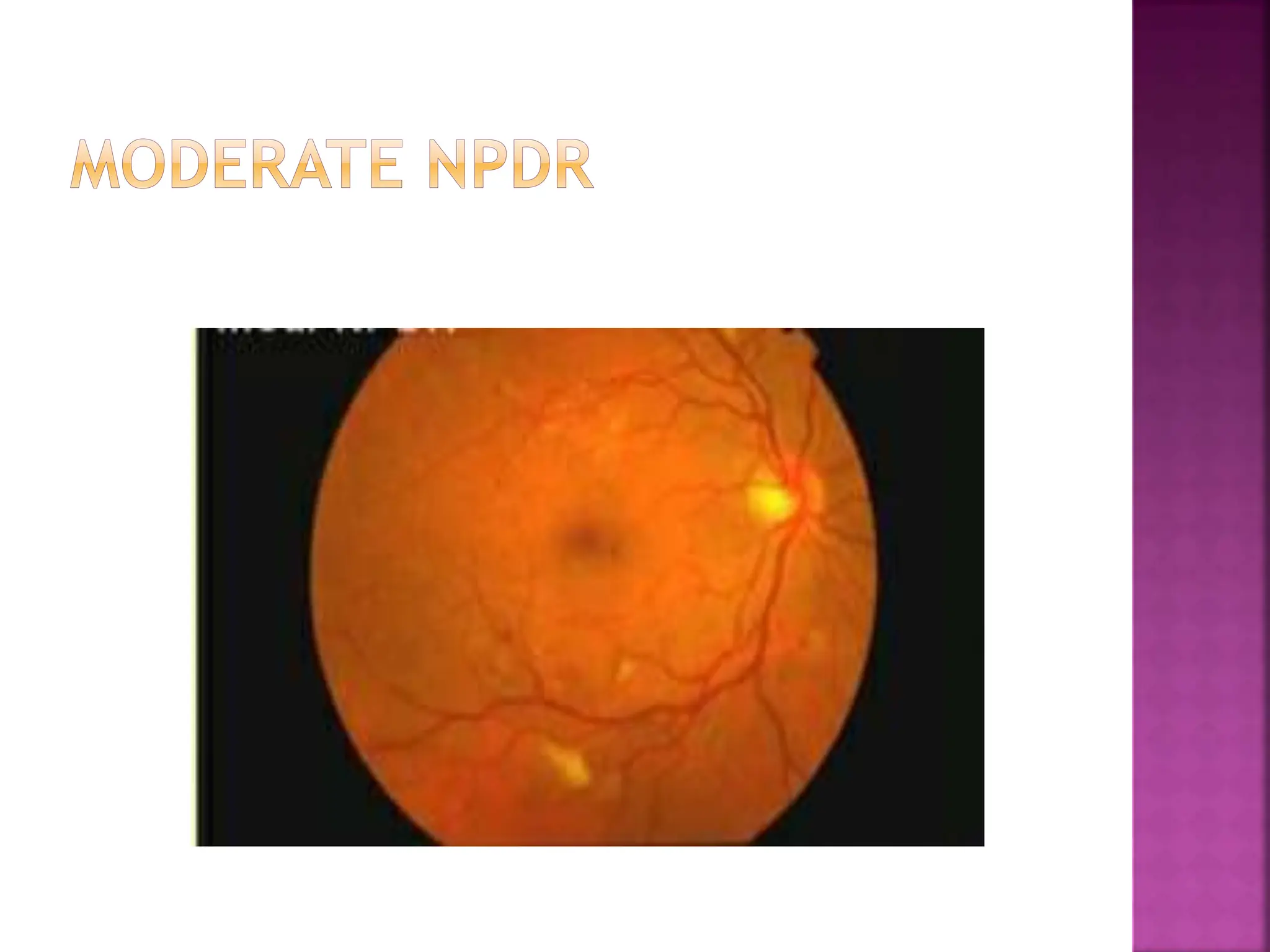 Diabetic retinopathy.pptx on diabetic changes in Retina | PPT