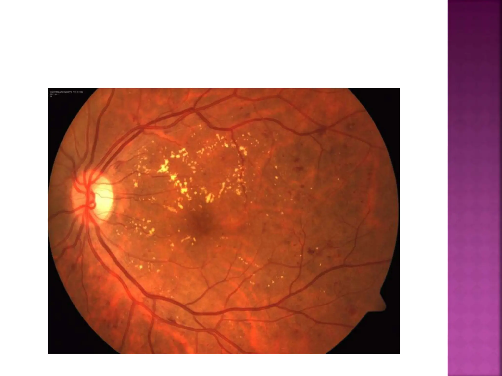 Diabetic retinopathy.pptx on diabetic changes in Retina | PPT
